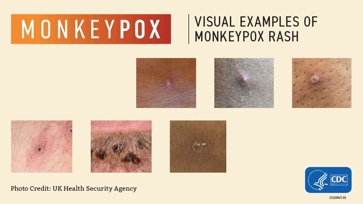 Department Of Health Communicable Disease Service Monkeypox Toolkit Department Of Health Communicable Disease Service Monkeypox Toolkit